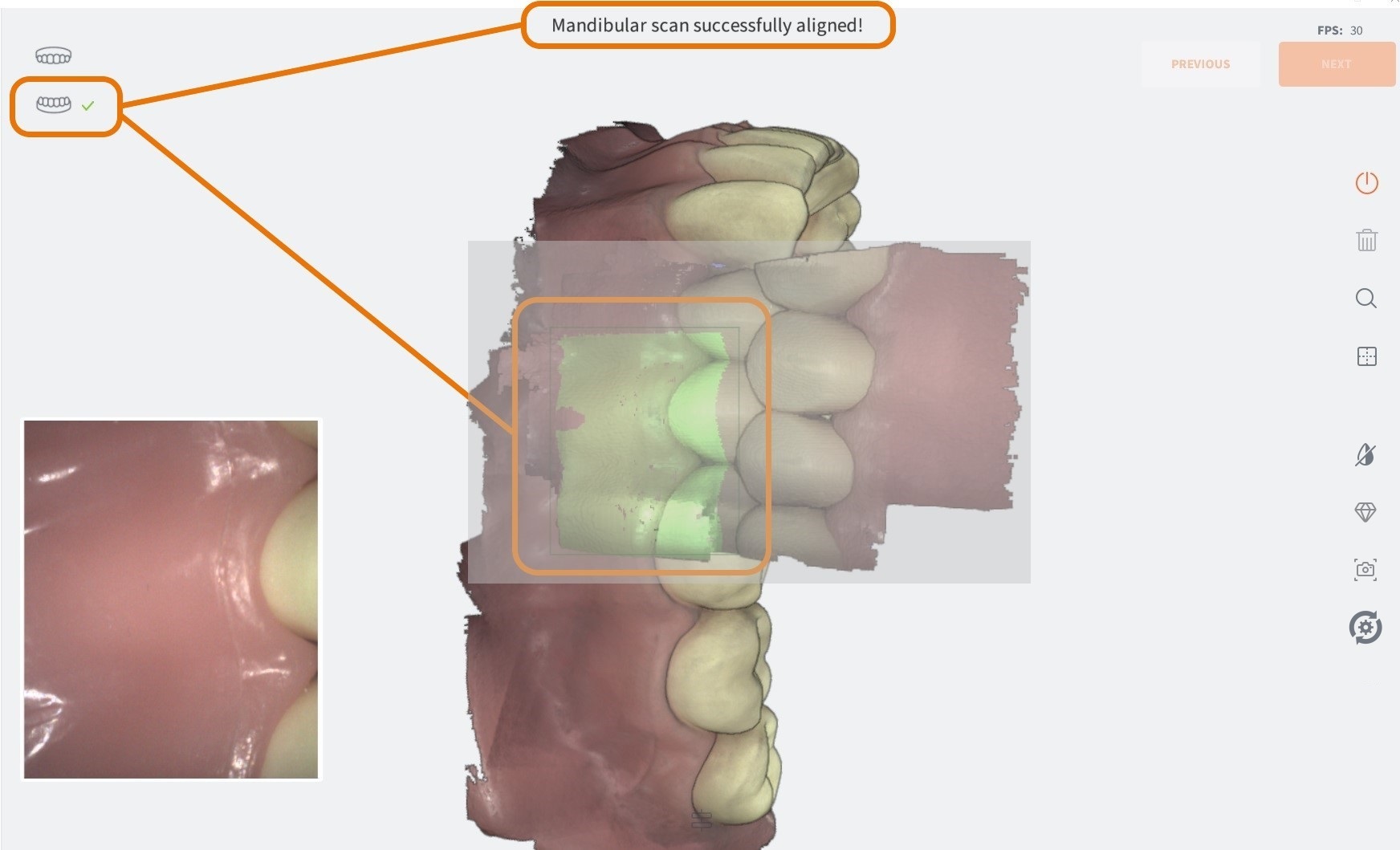 Automatic Bite Alignment - 3DISC Online Help