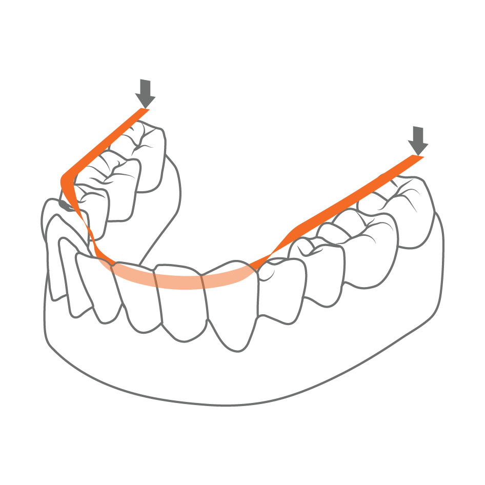Scanning the Maxillary Arch - 3DISC Online Help