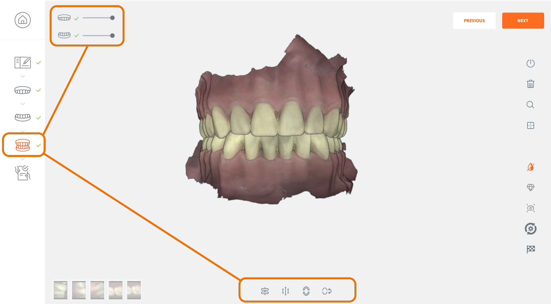 Automatic Bite Alignment - 3DISC Online Help